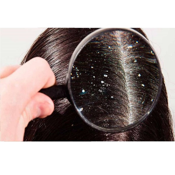 Cuidado Capilar | Tratamiento Caspa – HYPERSOLUTIONS